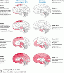 StopCTE – The Patrick Risha CTE Awareness Foundation CTE stages pic ...